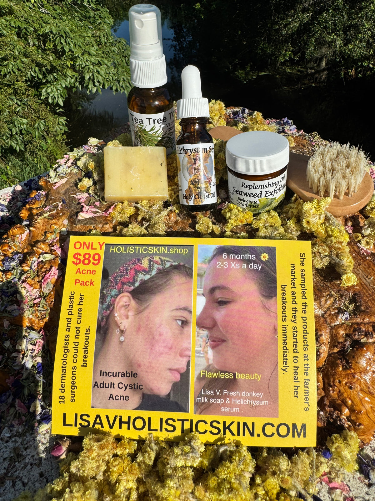Acne Pack – Lisa V. Holistic Skin Care